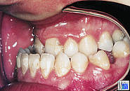 Zahnklinik Medeco Koblenz und Zahnarztzentrum: Progene Verzahnung