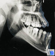 MEDECO Zahnklinik Augsburg: Mandibuläre Prognathie