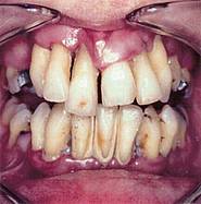 Zahnklinik MEDECO Hamburg: Chronische Parodontitis