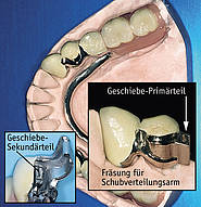 Zahnklinik MEDECO Hamburg: Teilprothesen