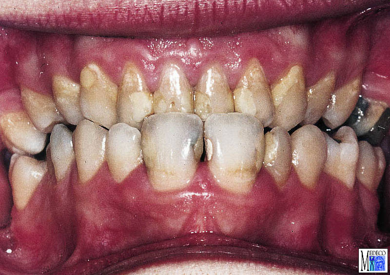 Mandibuläre Prognathie