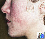 Mandibuläre Prognathie