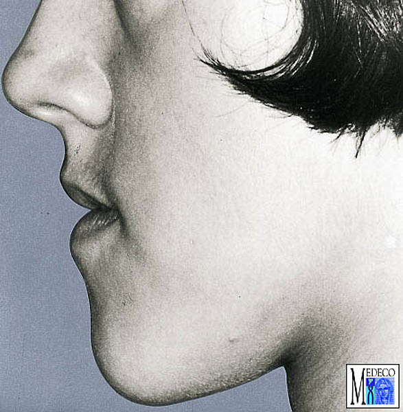 Mandibuläre Prognathie