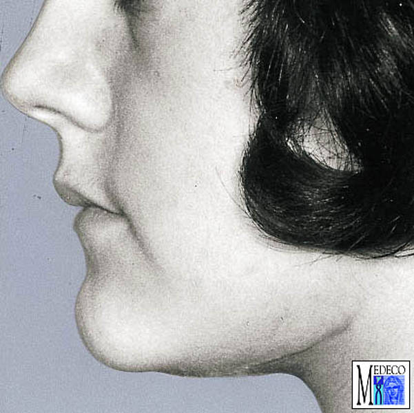 Mandibuläre Prognathie