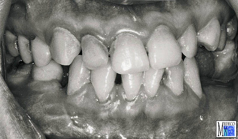 Mandibuläre Prognathie