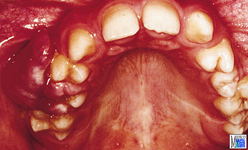 Reaktive Hyperplasien (reparative Granulome)