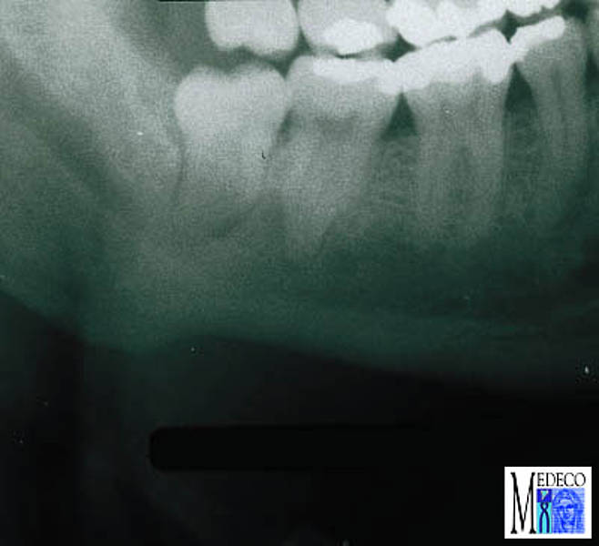Inflammatory soft-part swellings