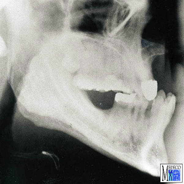 Maxilläre Retrognathie