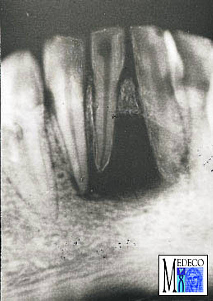 Kystes radiculaires