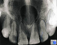Nicht odontogene Zysten und Fisteln