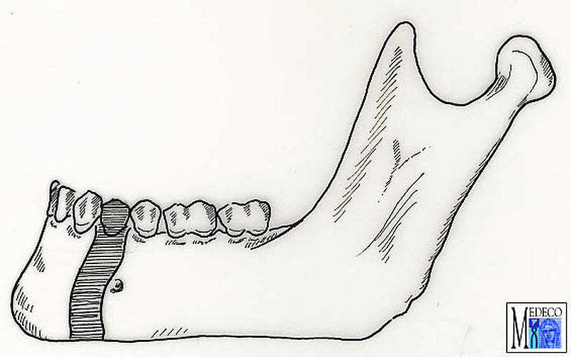 Mandibuläre Prognathie