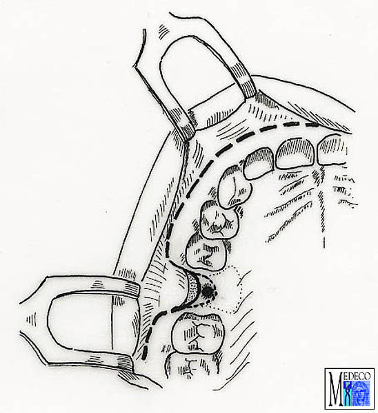 Eröffnung der Kieferhöhle bei der Zahnextraktion