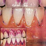 Periodontitis marginalis acusada