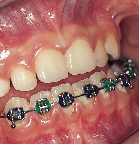 Festsitzende Apparaturen