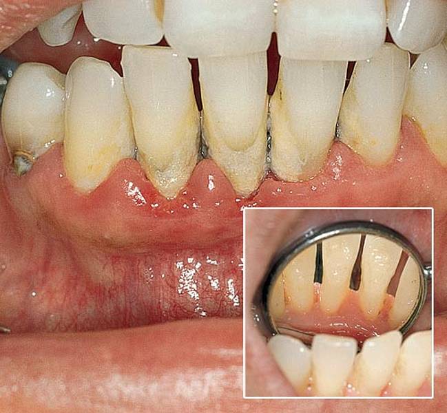 Chronische Parodontitis