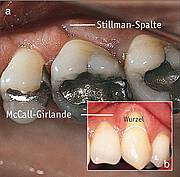 Parodontitis caused by external factors