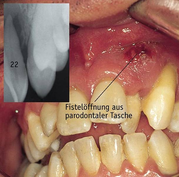 Entzündungen nach chirurgischen Eingriffen