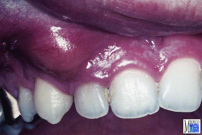 Inflammatory soft-part swellings