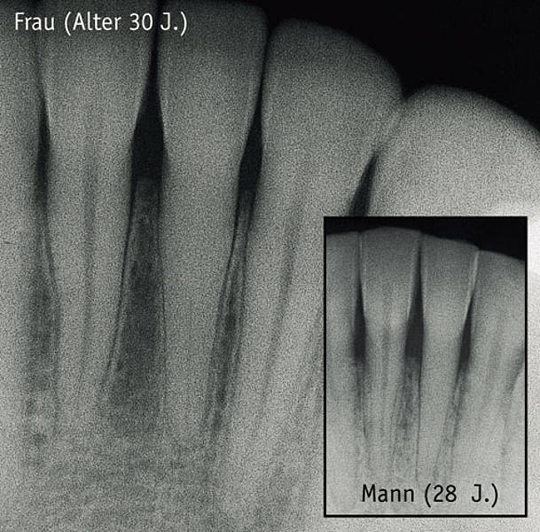Diagnose und Einteilung von Pulpaerkrankungen
