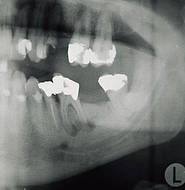 Diagnose und Einteilung von Pulpaerkrankungen