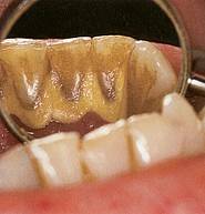 Zahnstein / Konkremente