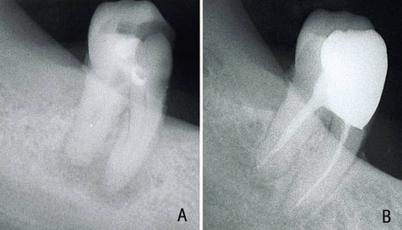 Diagnose und Einteilung von Pulpaerkrankungen