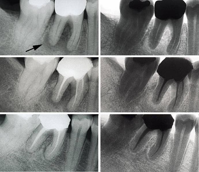 Diagnose und Einteilung von Pulpaerkrankungen
