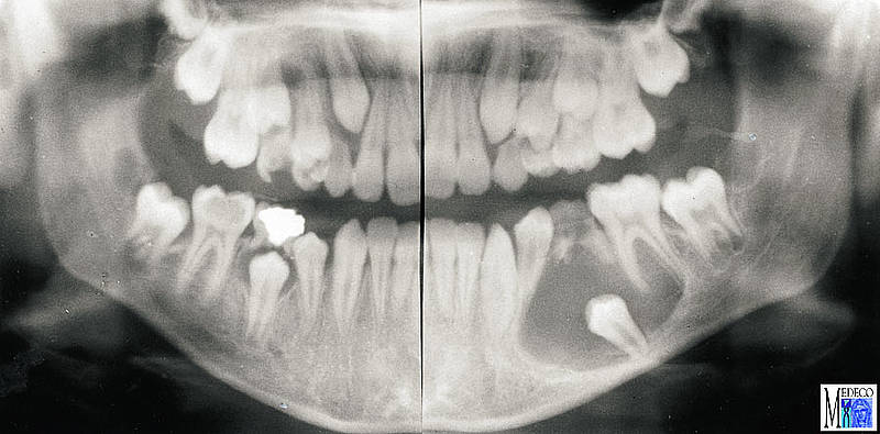 Kystes folliculaires