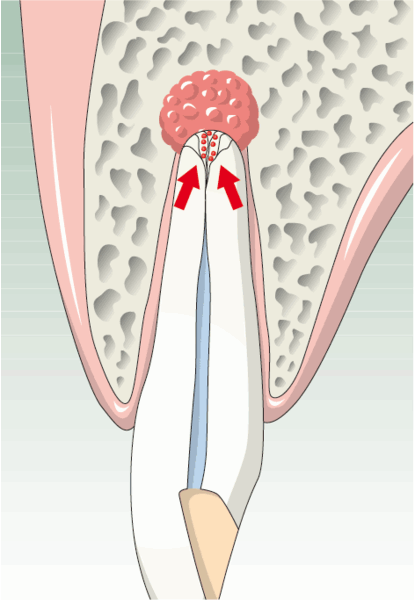 Résection apicale