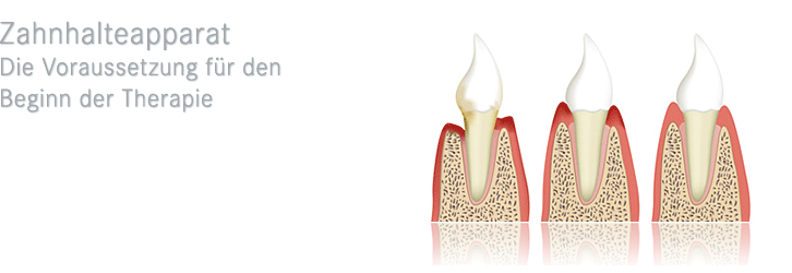 Geweberegeneration bei Parodontitis